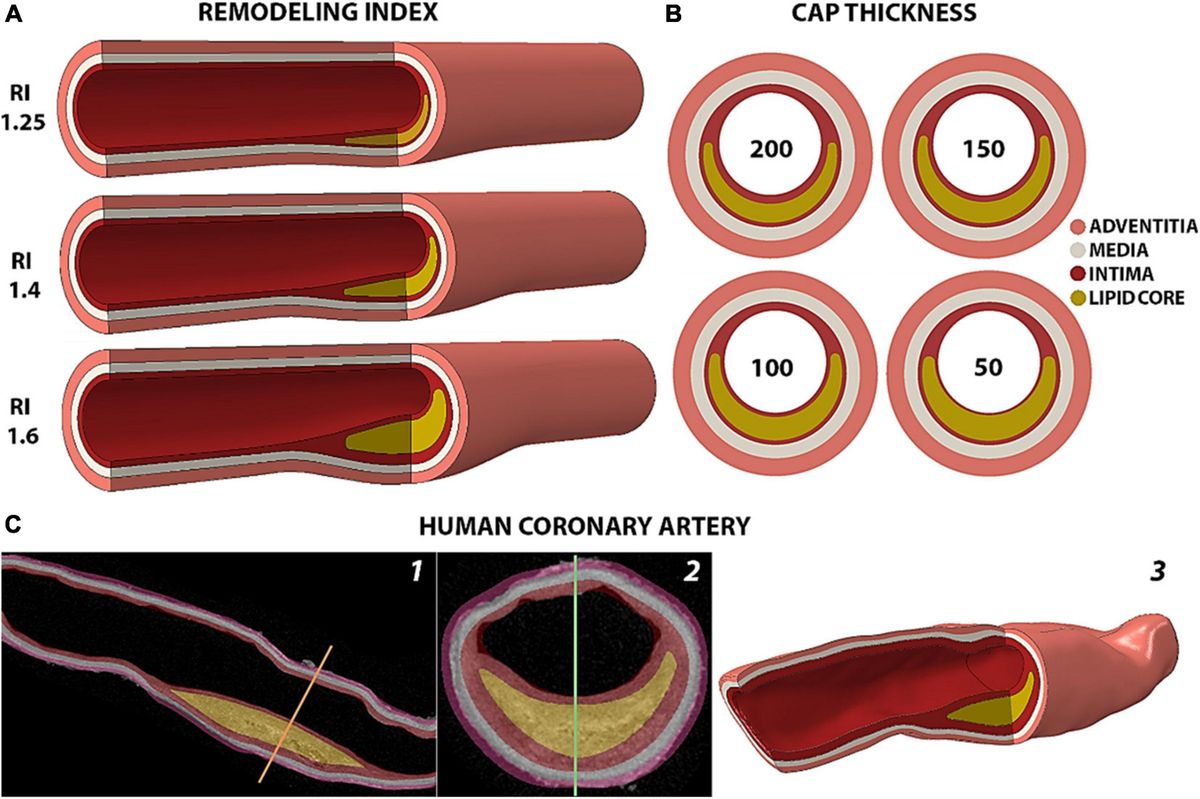mixed morphology plaque