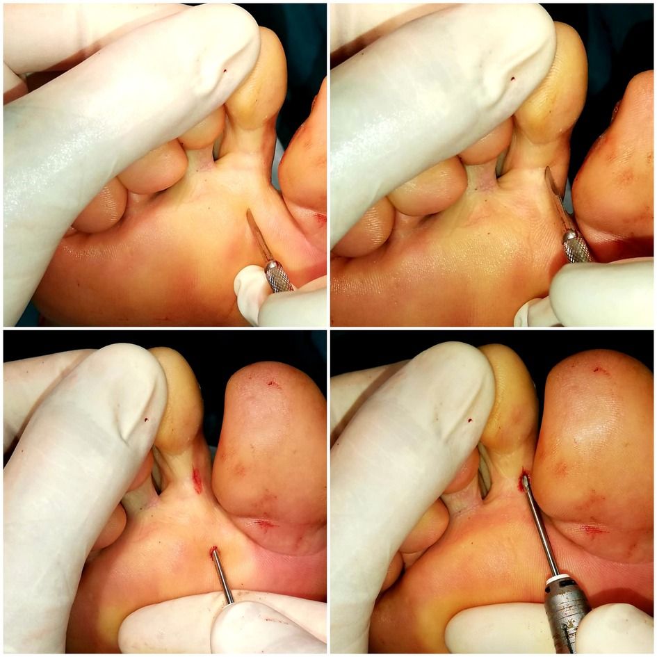 big toe thumb surgery