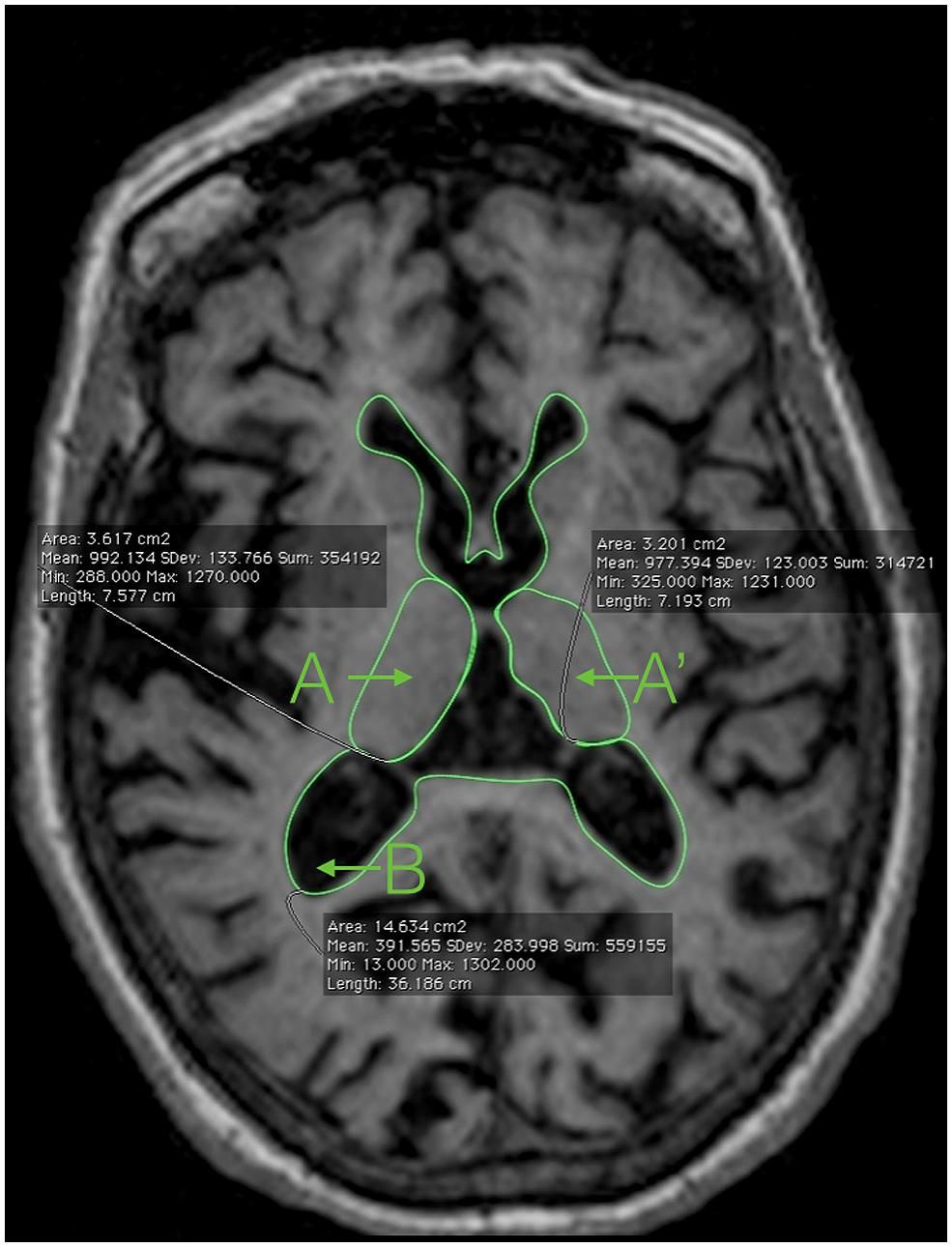 interthalamic adhesion radiology