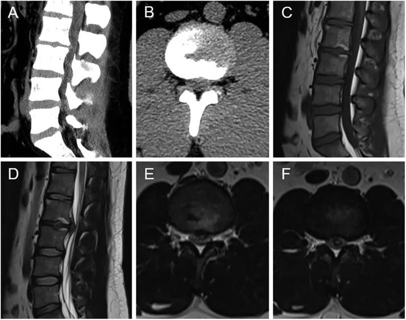 myelogram herniated disc