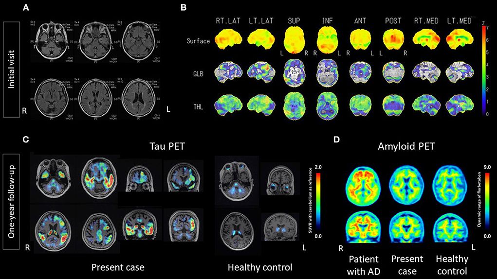 logopenic ppa diagnosis