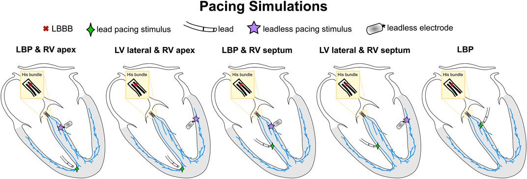 biventricular pacemaker uk
