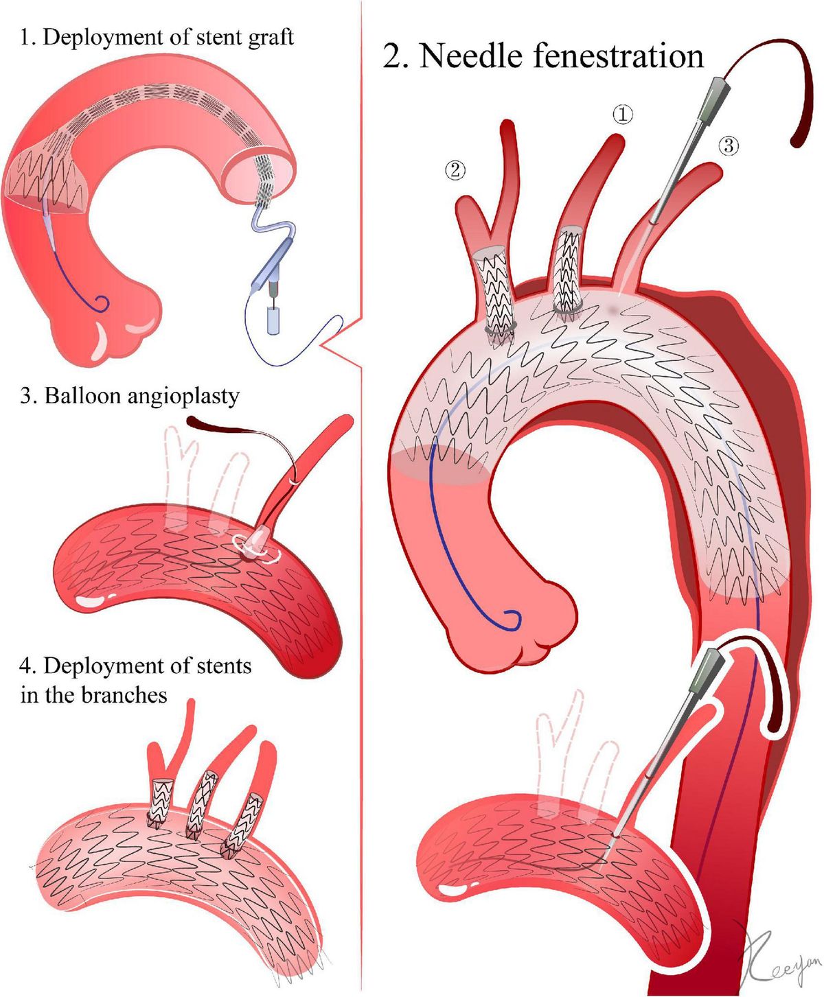 fenestrated sequence
