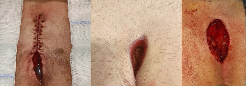 healed pilonidal cyst