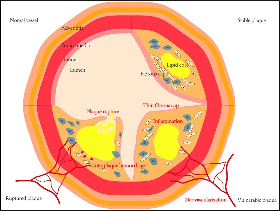 atherosclerosis plaque