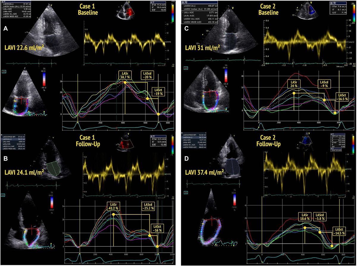 diastolic dysfunction chart ase