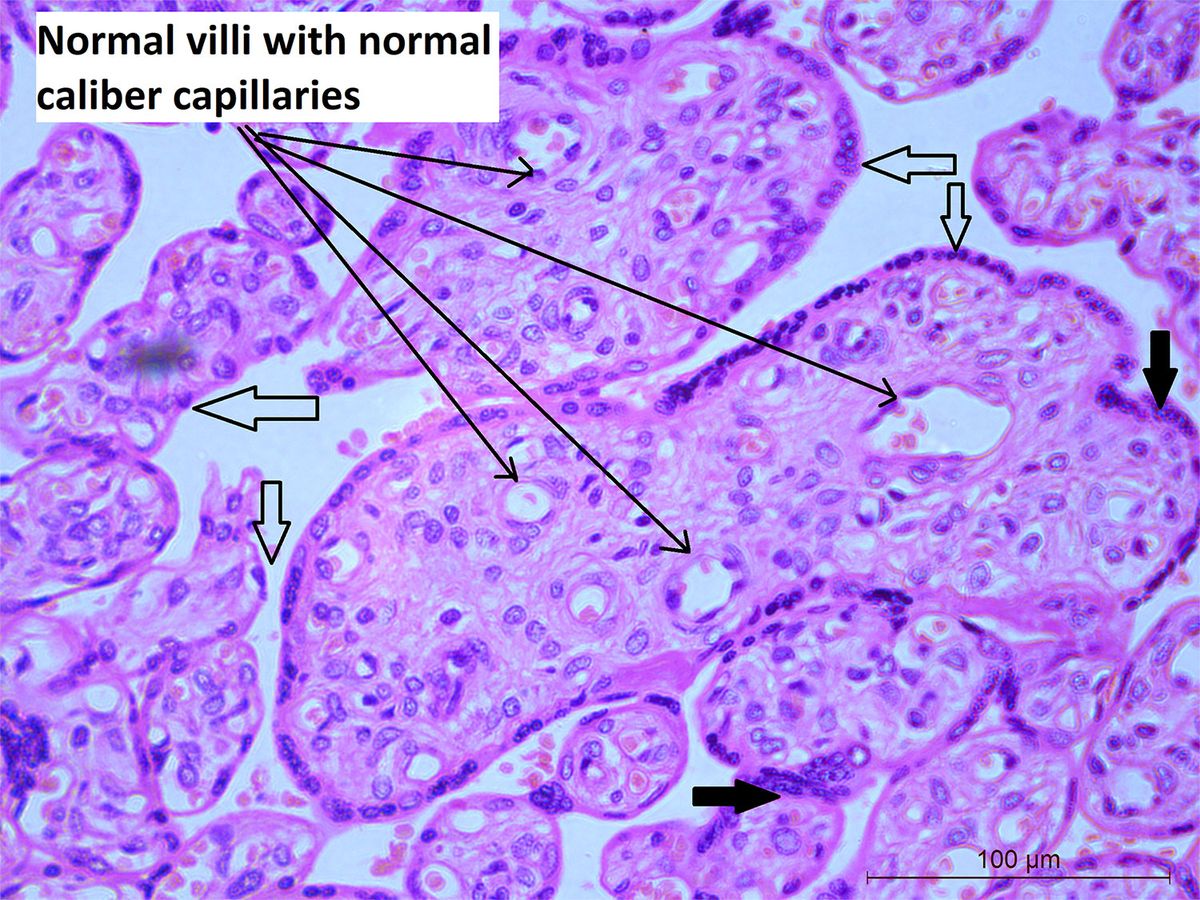 normal placenta pathology report