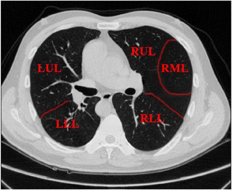 lung segments ct