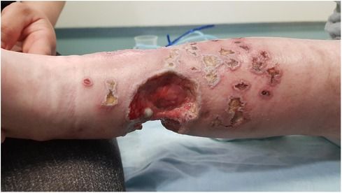cutaneous infection examples