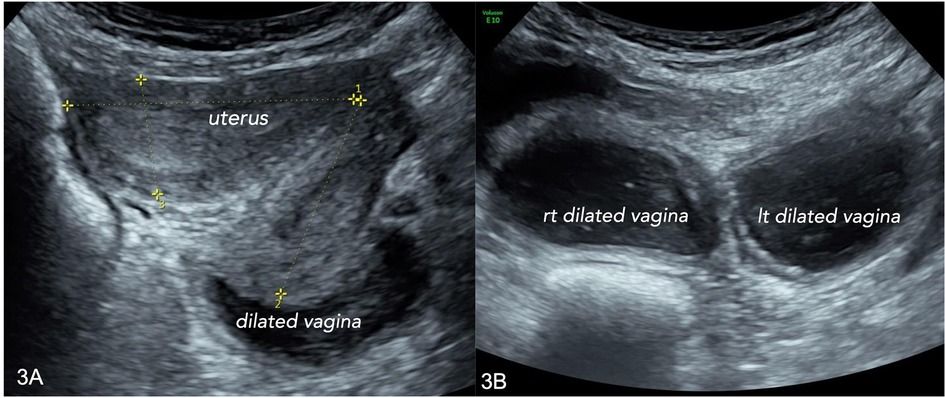 persistent urogenital sinus