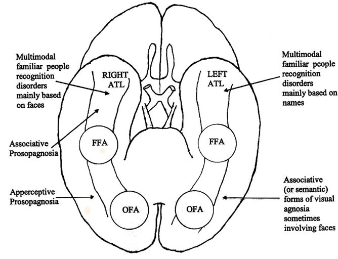 visual agnosia causes