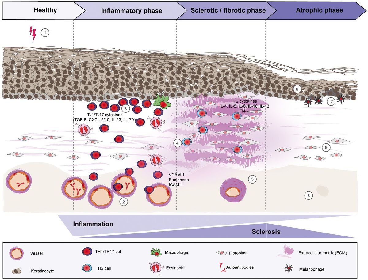 morphea scleroderma causes