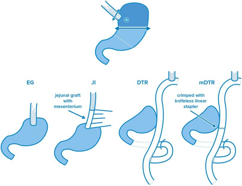 subtotal gastrectomy