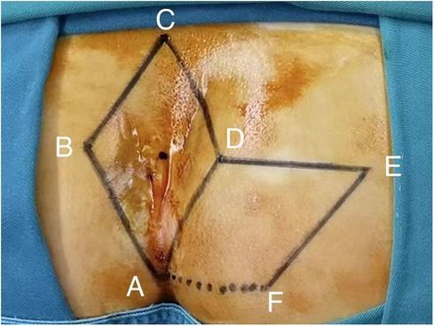 pilonidal sinus surgery types