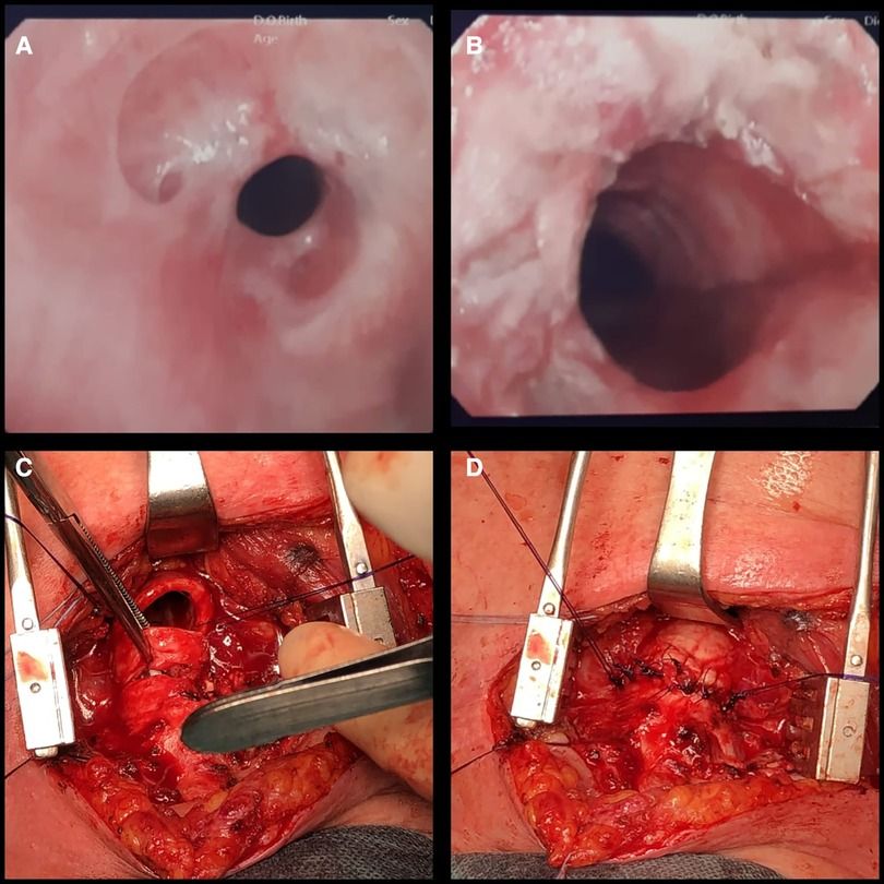 tracheal resection