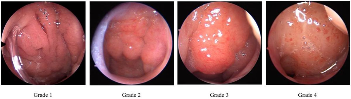 adenoids x ray grading