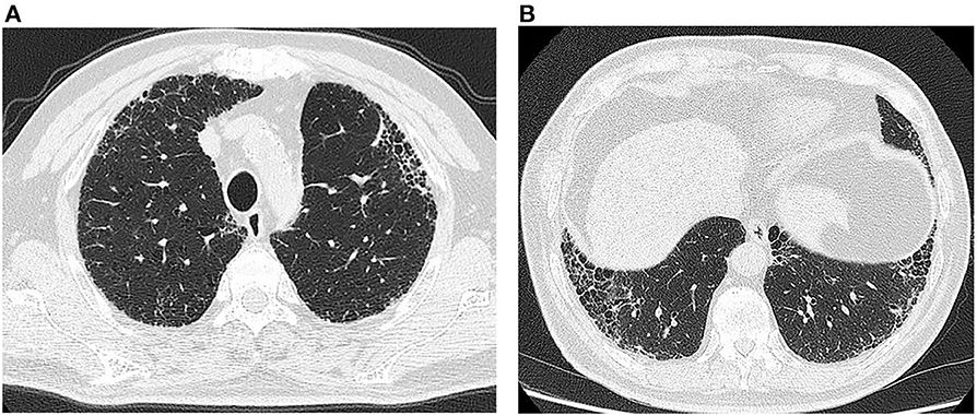 microscopic polyangiitis