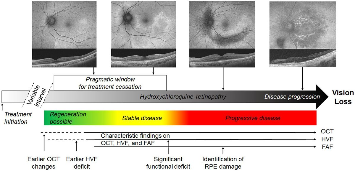 hydroxychloroquine eye side effects