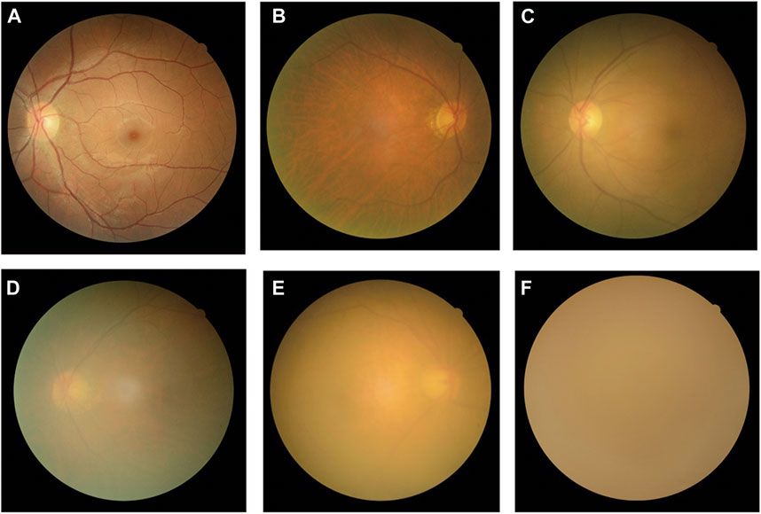 fundus eye test procedure