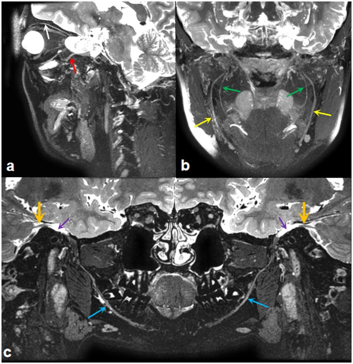 trigeminal nerve mri protocol