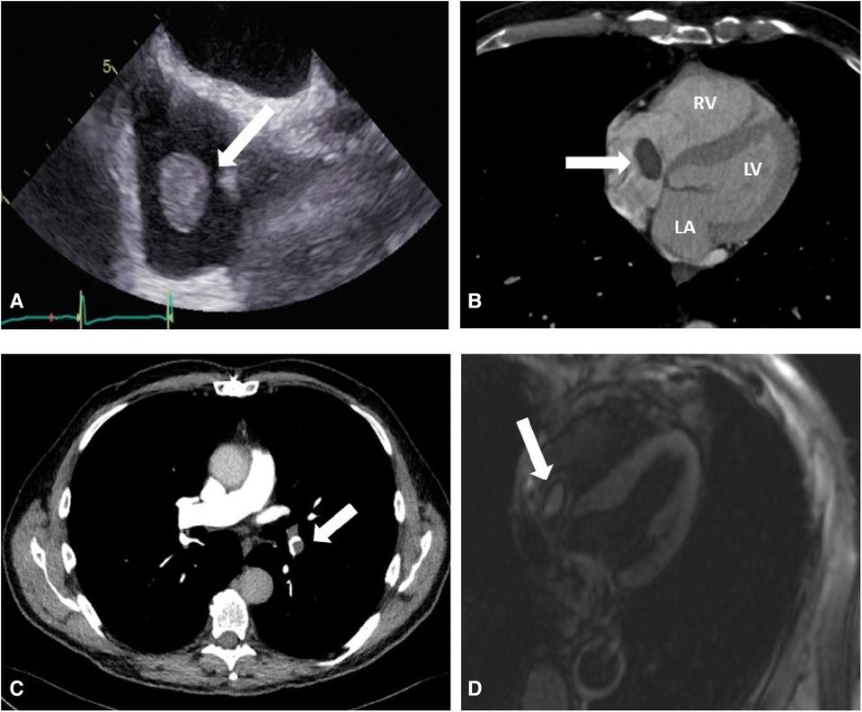 eustachian valve echo