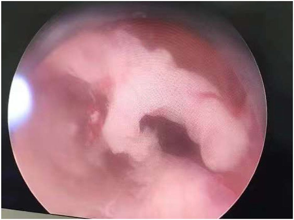 normal hysteroscopy report