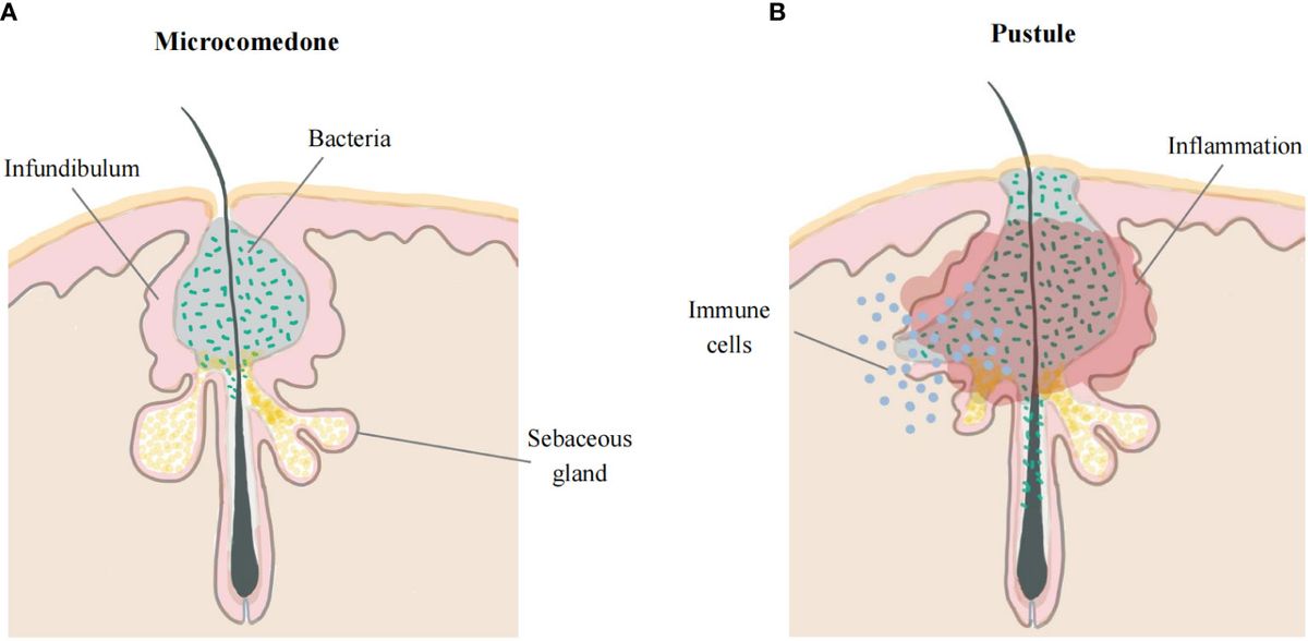 hyperkeratinization acne