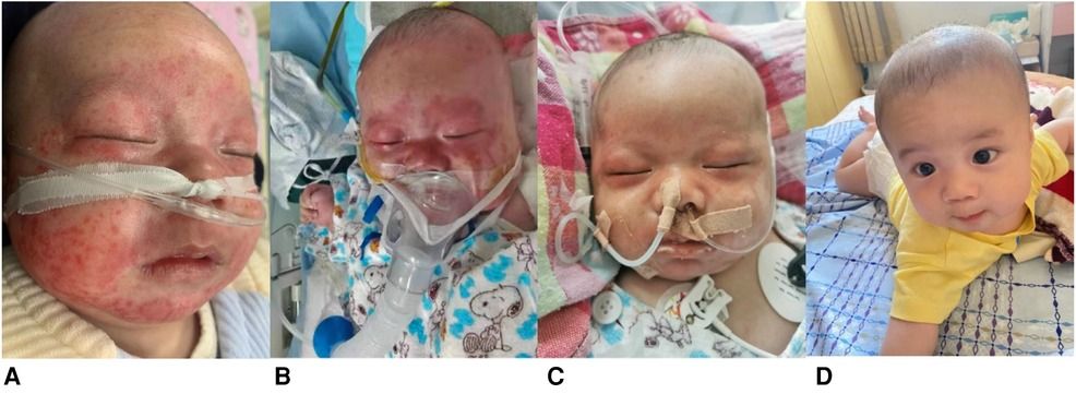 neonatal lupus erythematosus diagnosis