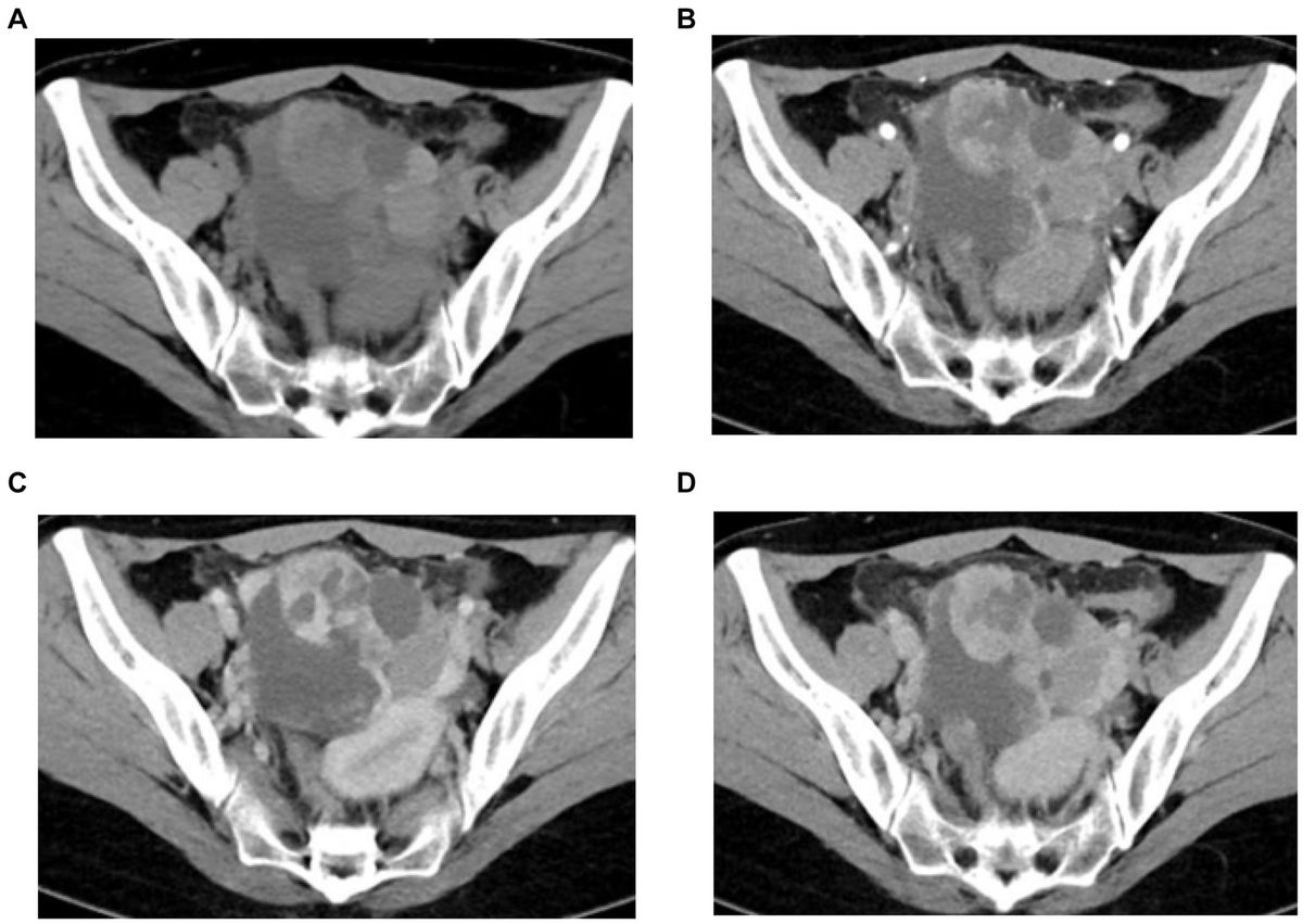 struma ovarii hyperthyroidism