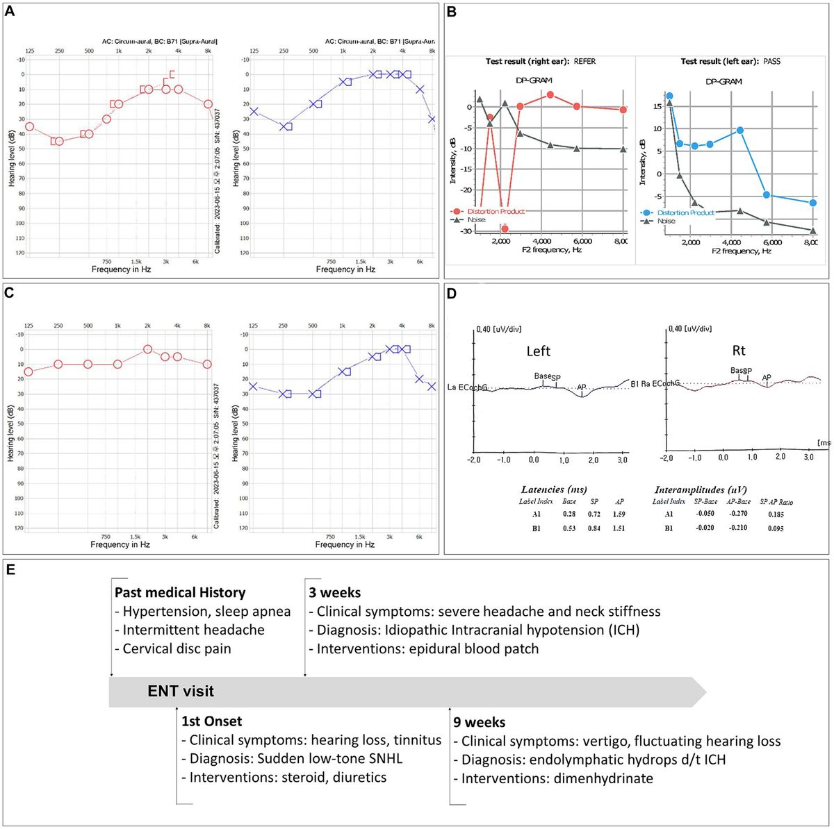 endolymphatic hydrops audiogram