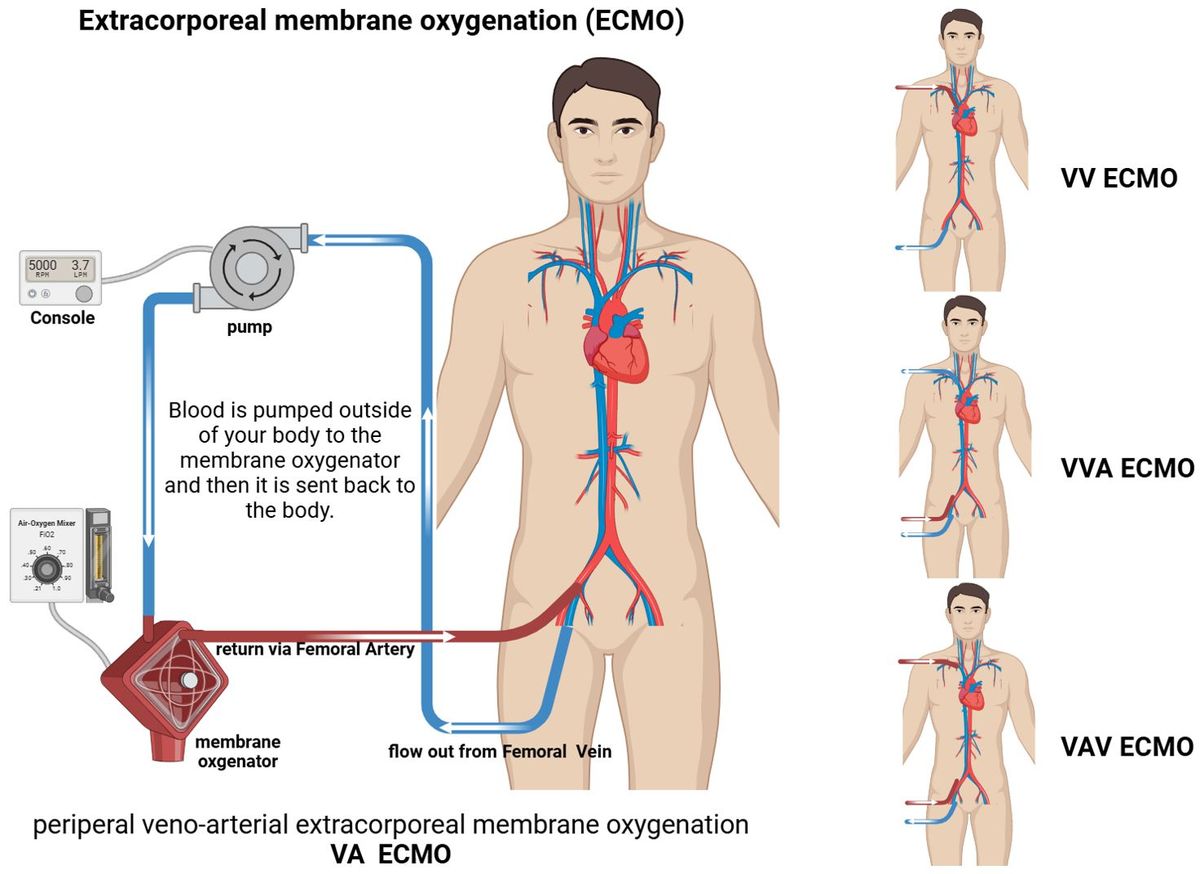 vv ecmo settings