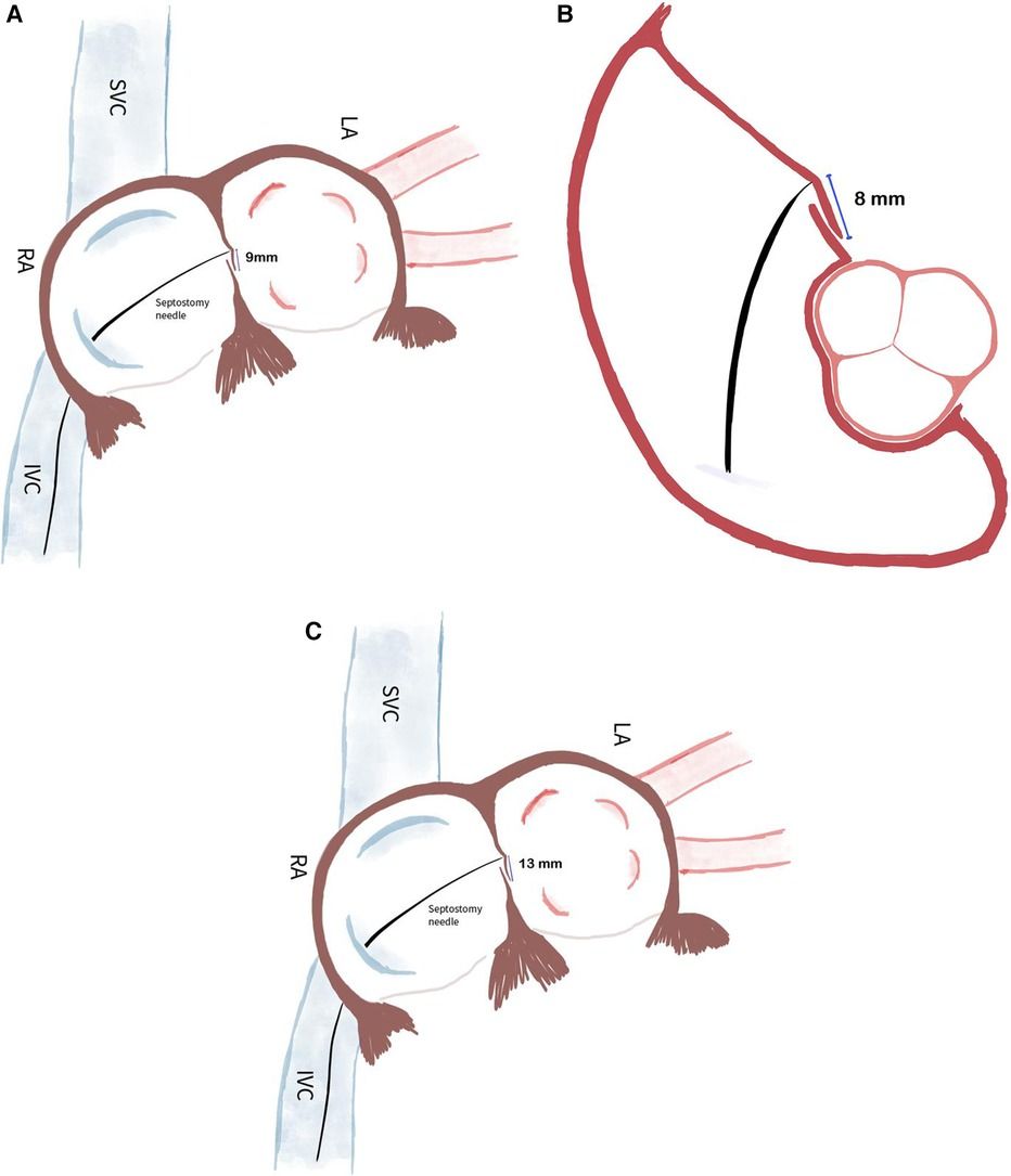 septostomy procedure