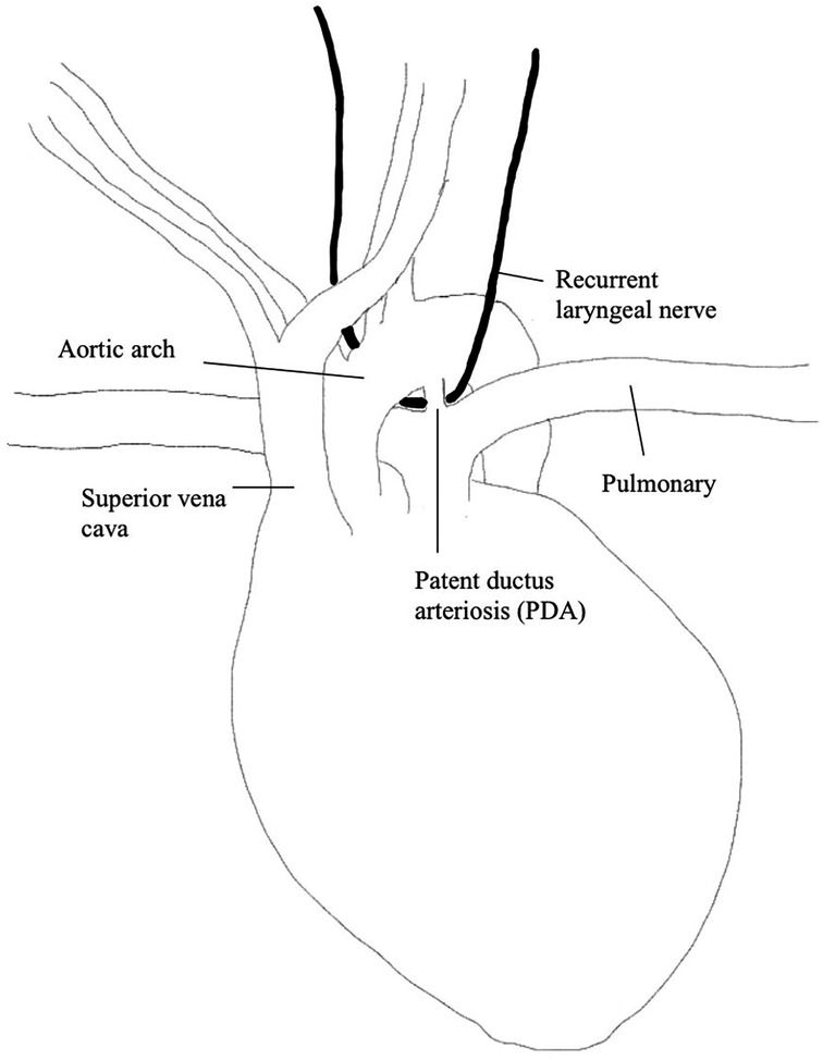 paramedian position of vocal folds