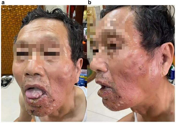 shingles face paralysis