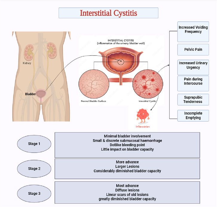 cystitis treatment