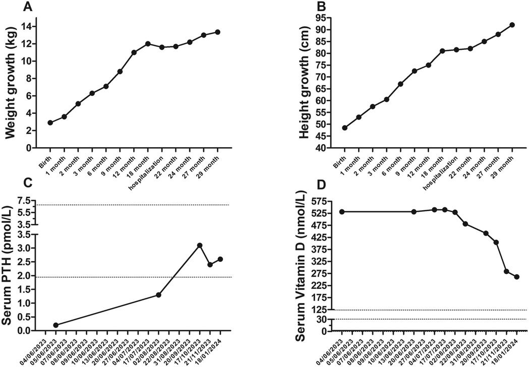 hypervitaminosis d level