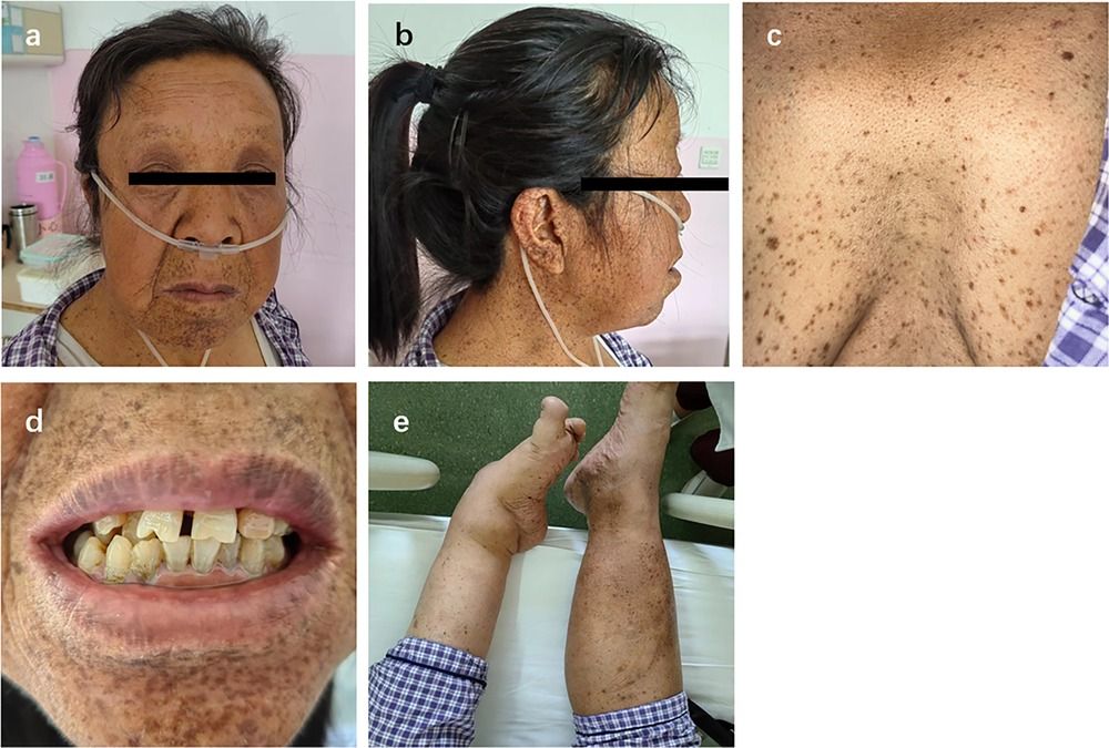 multiple lentiginosis