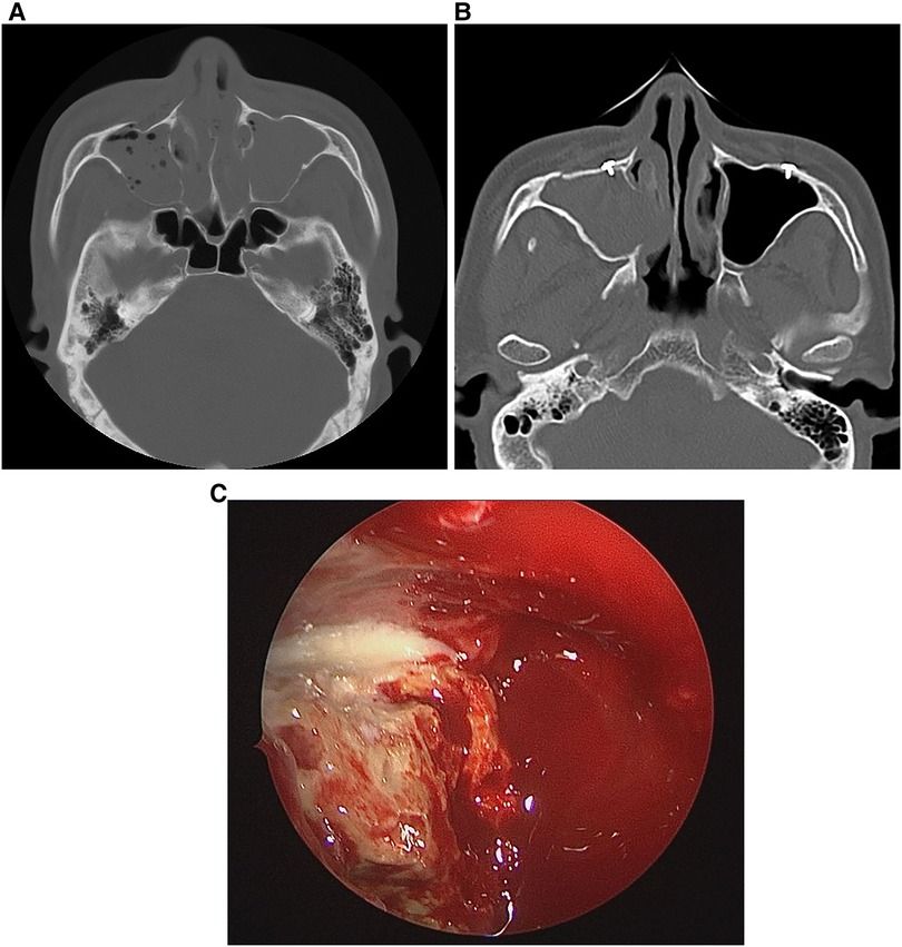 maxillary sinus bone infection
