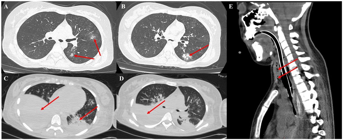pulmonary mucormycosis case report