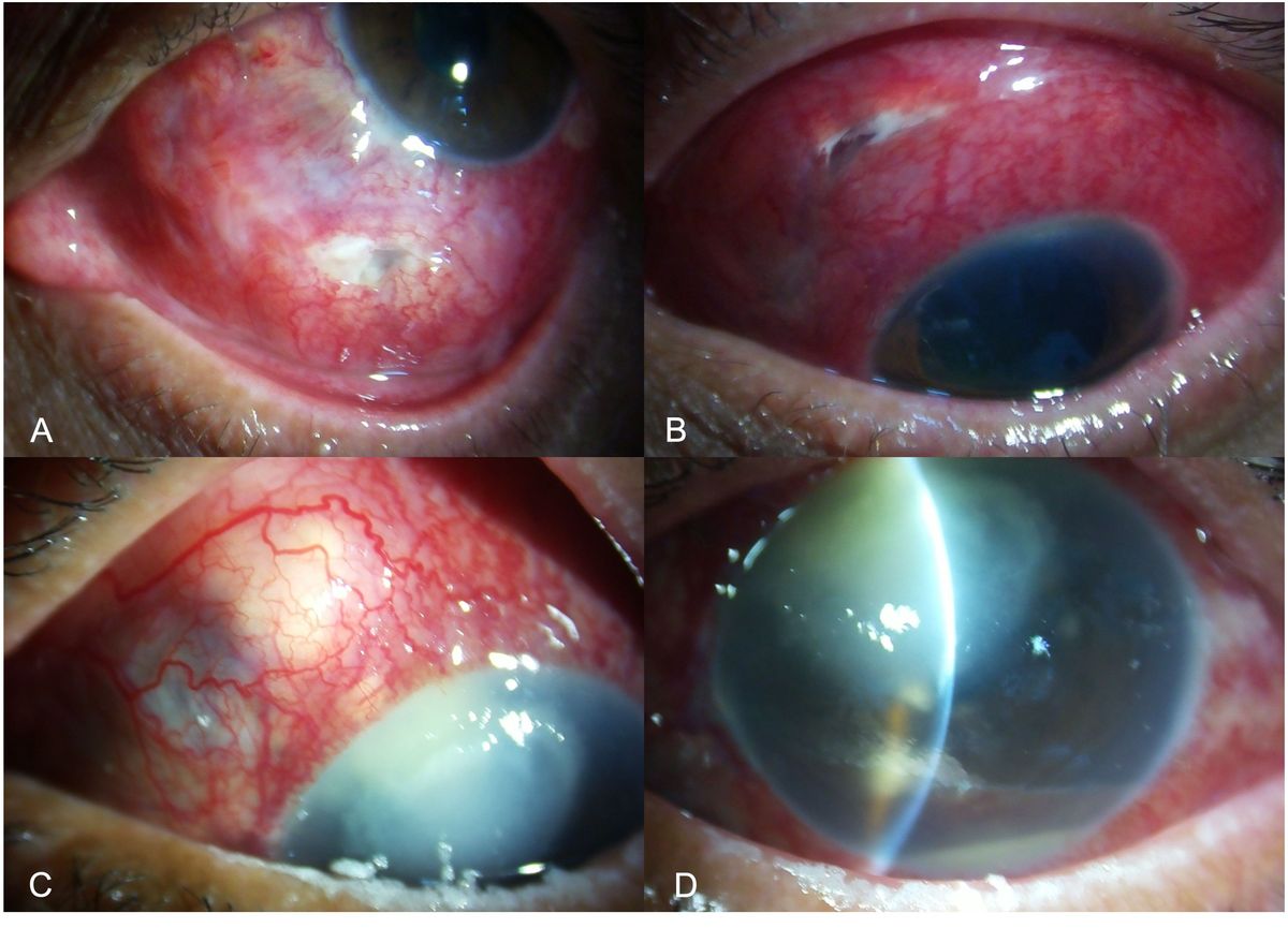diffuse scleritis causes