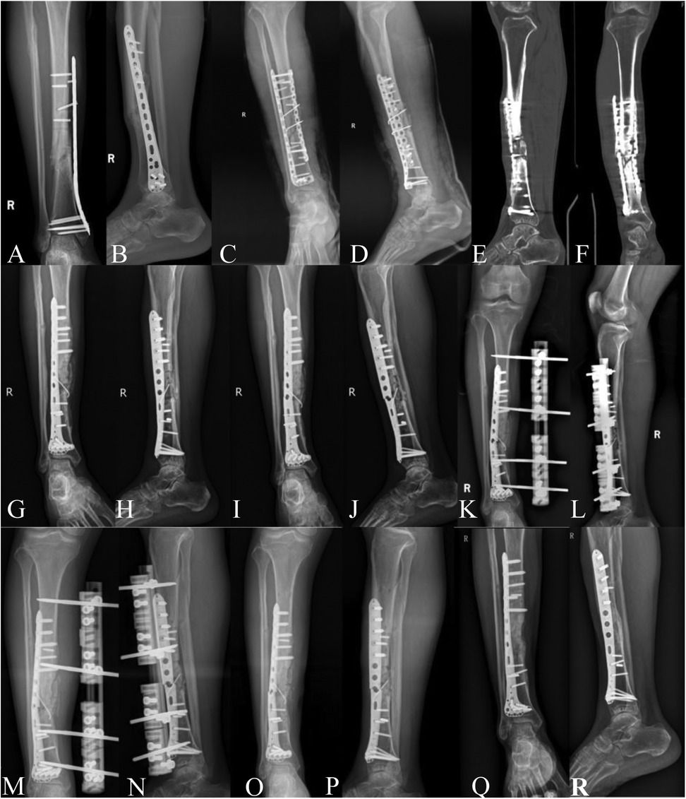 tibia bone operation