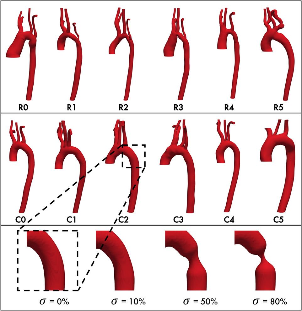 aortic dissection icd 10