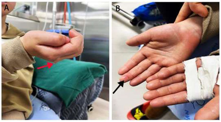 hyperhidrosis hands surgery