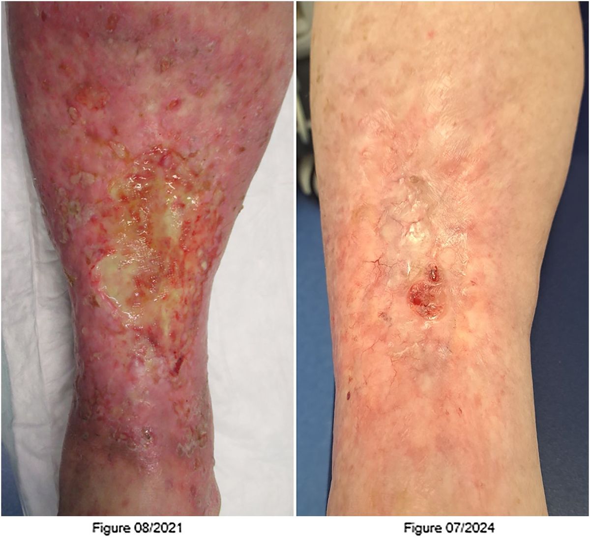 basal cell carcinoma on leg for years
