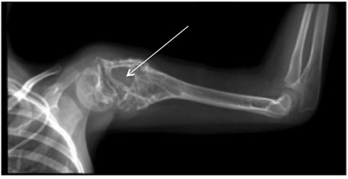 ewing sarcoma spread