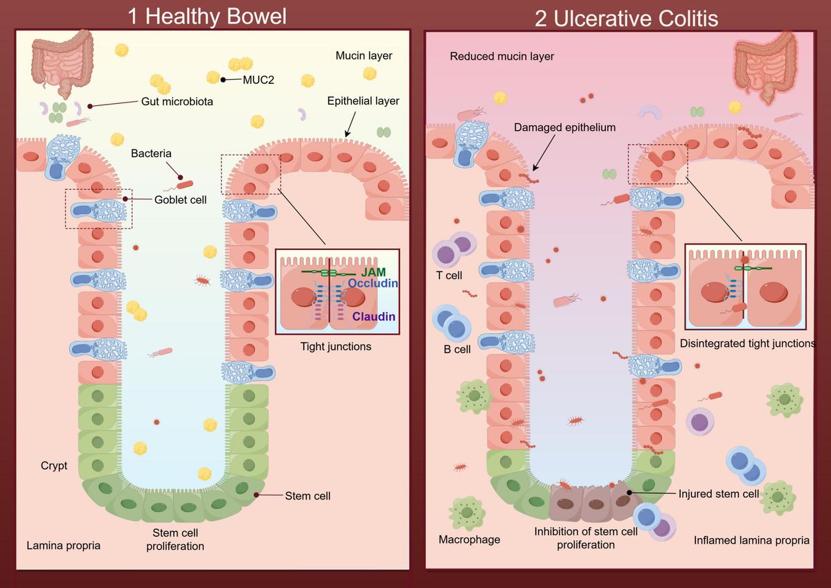 quiescent ulcerative colitis