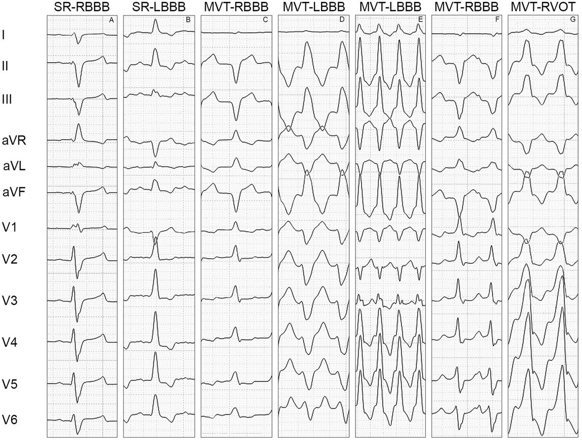 basel algorithm ventricular tachycardia