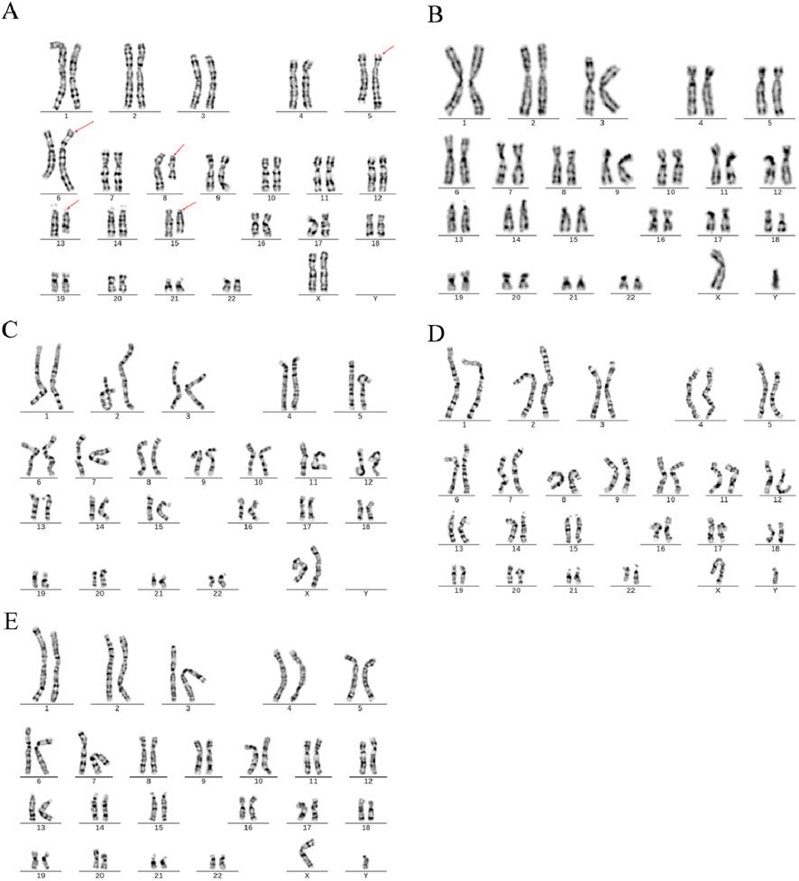 karyotype monosomy