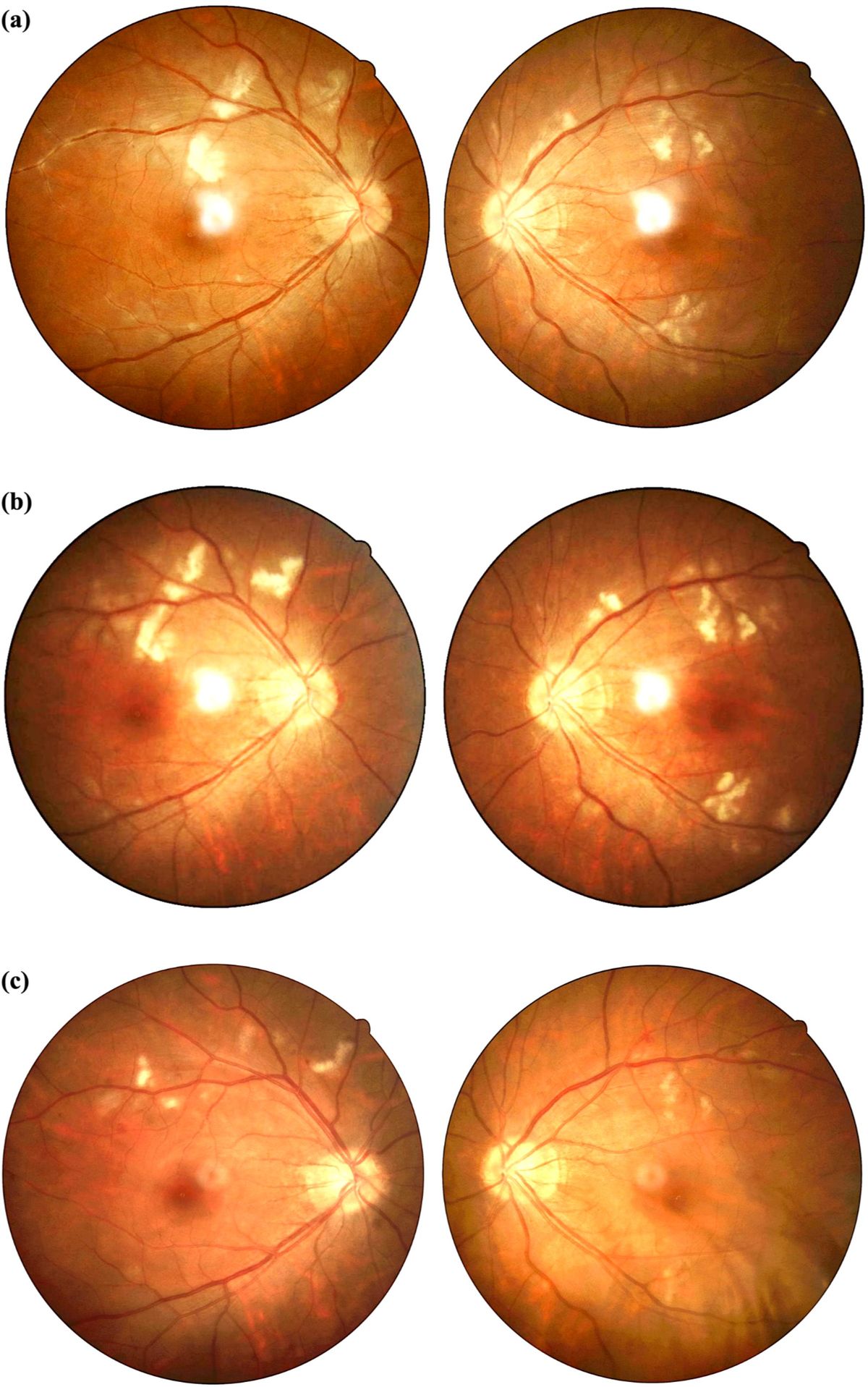 vasculitis ocular