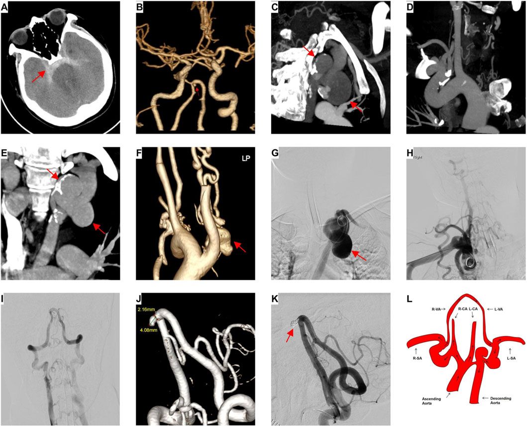 thoracic aneurysm cks